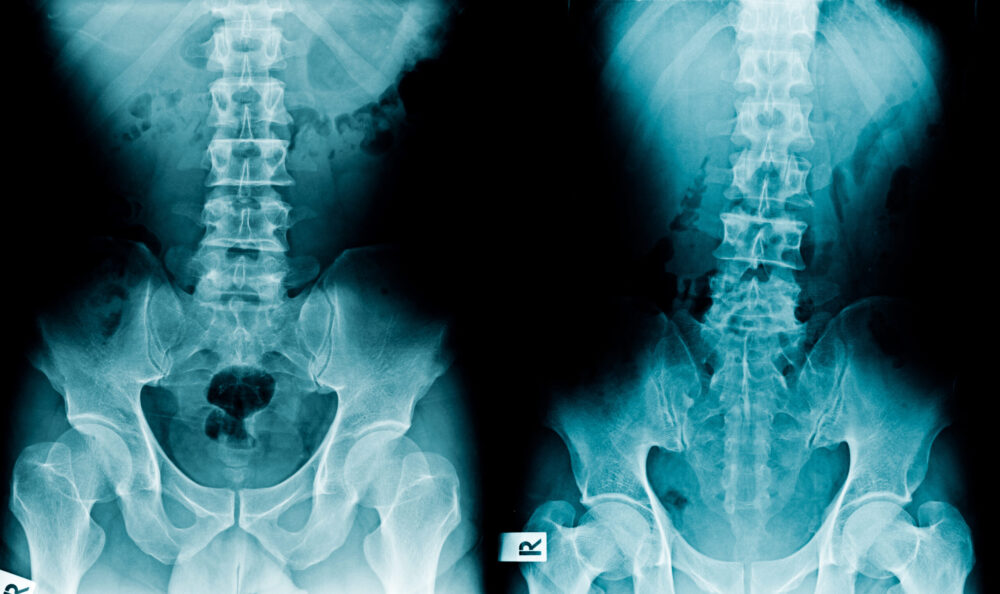 Key Facts About Spinal Cord Injuries in CT